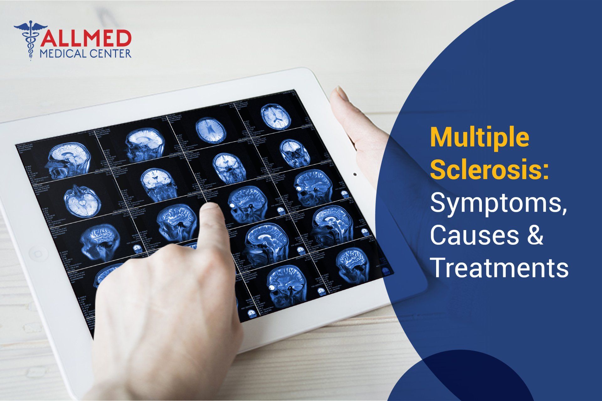 Multiple Sclerosis Symptoms Causes Treatments Multiple Sclerosis Symptoms Causes Treatments