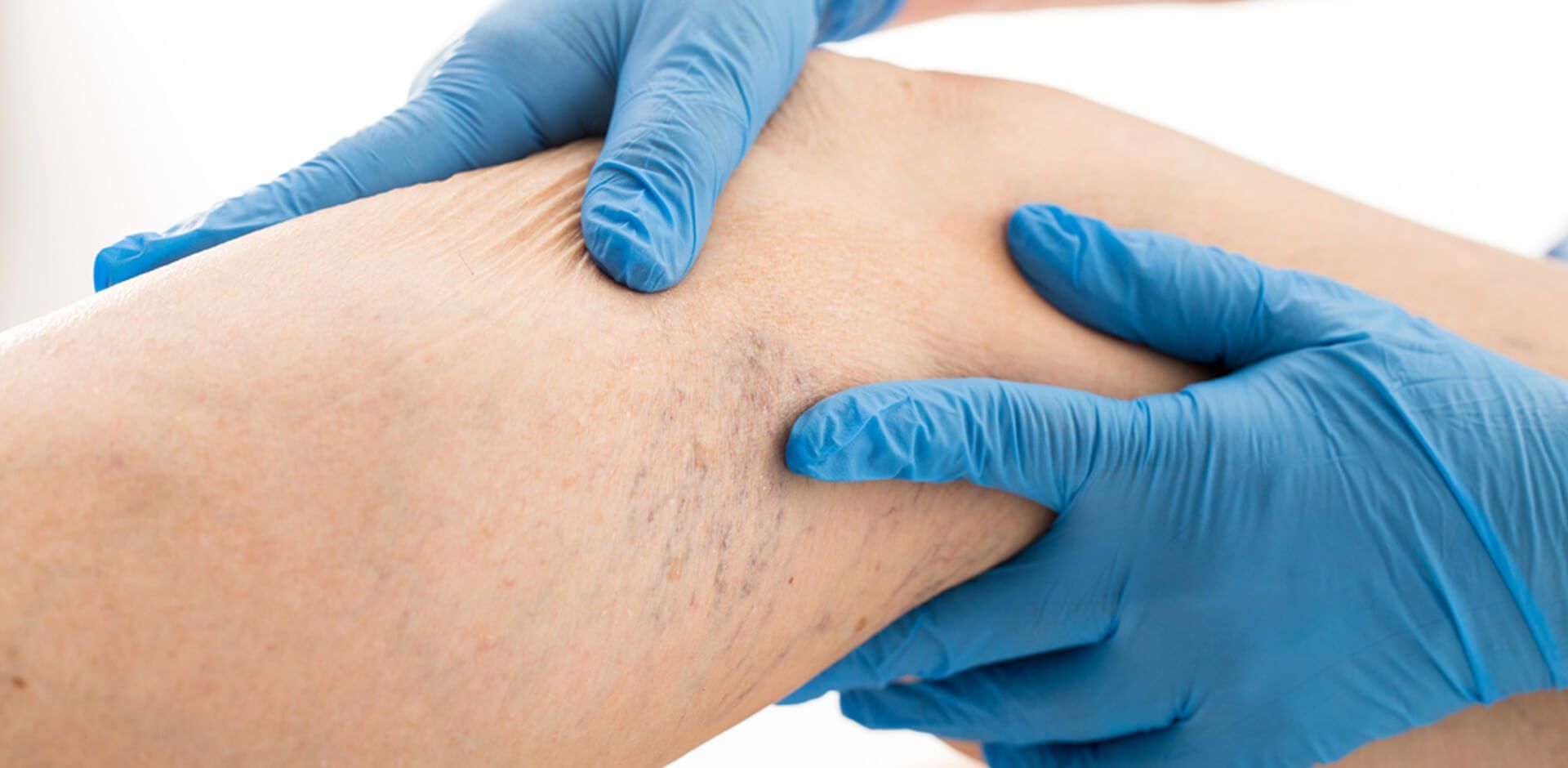 ¿Cómo desaparecer las várices para siempre sin dolor?