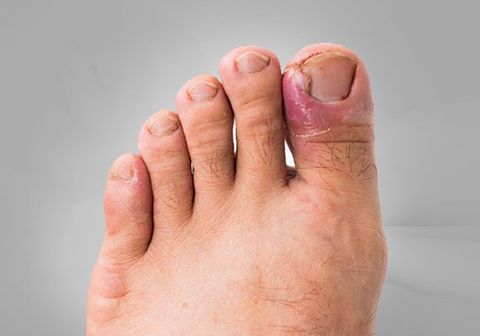 Ingrown Toenails Treatment | Michael Veltre, DPM, PC