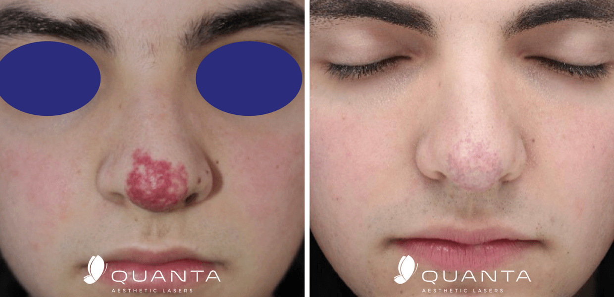 Rosacea Treatment & Laser Vein Removal | Maryland