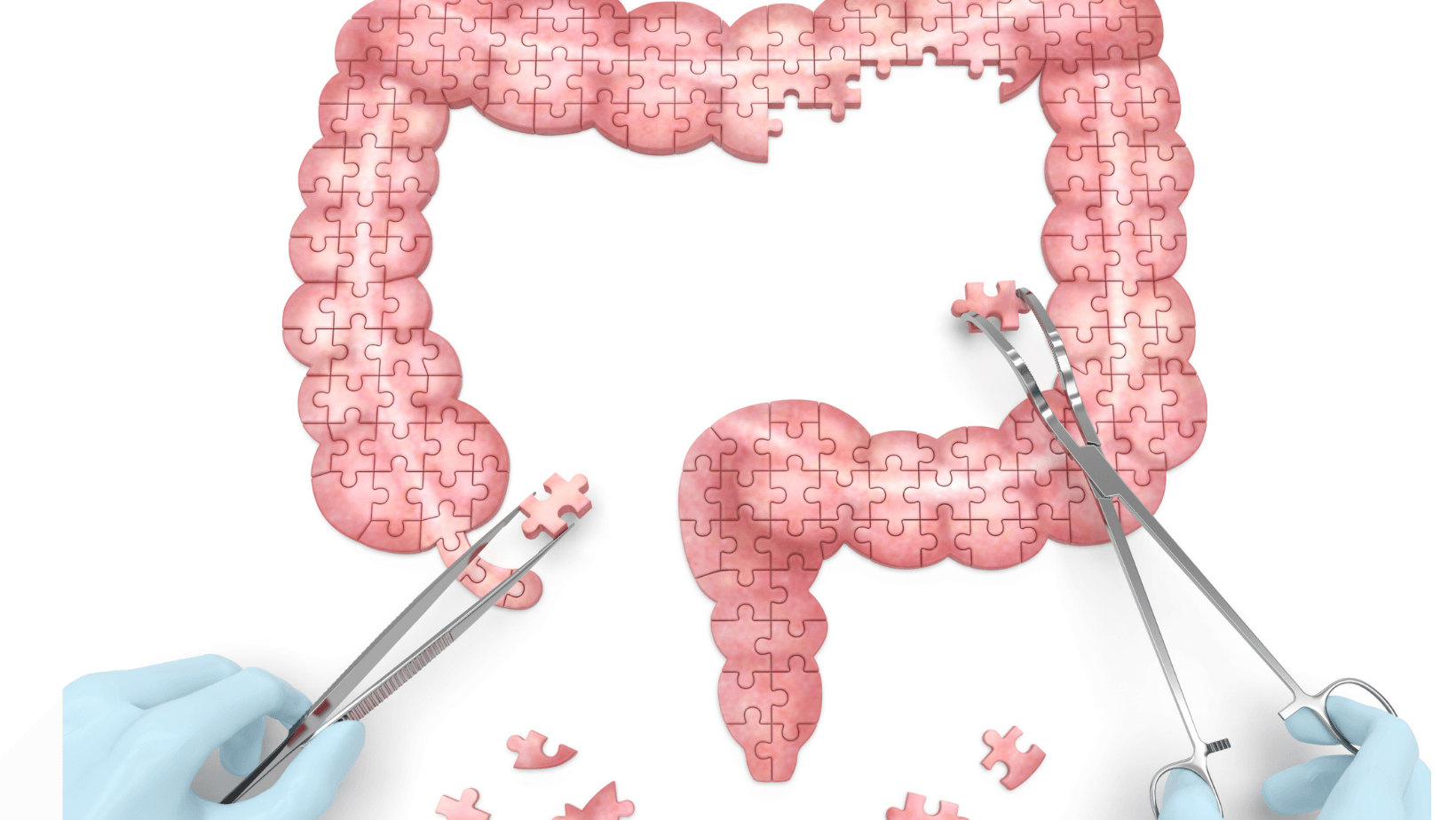 Diverticulitis - Symptoms and Causes - Avicenna Health