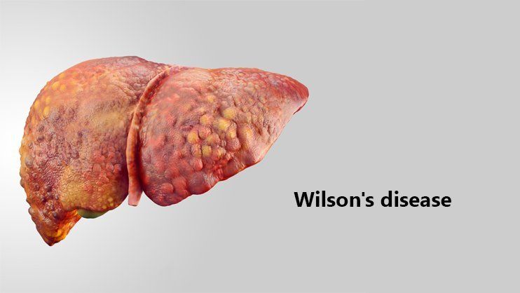 Wilsons Disease - Symptoms, Causes, and Treatment Avicenna Health