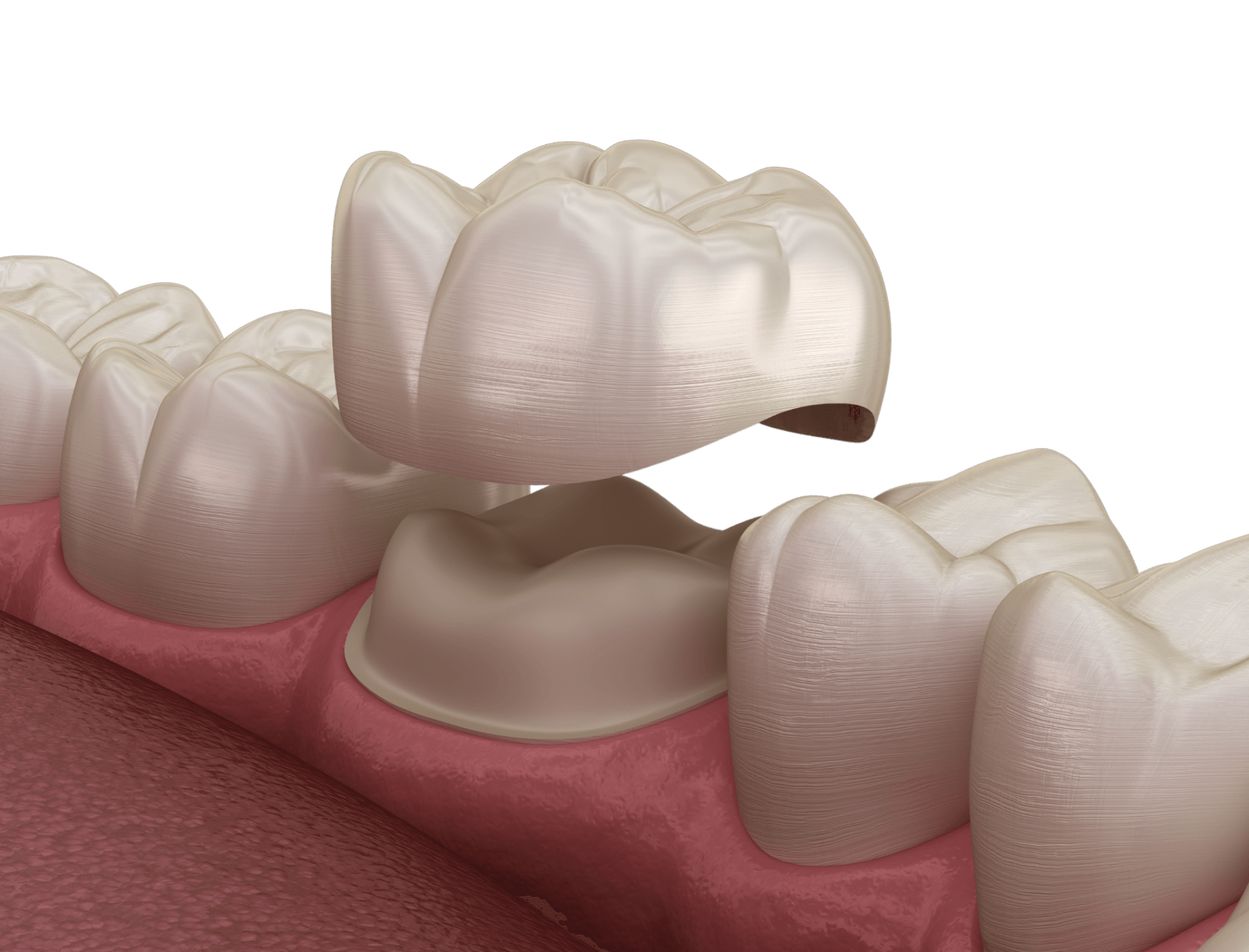 Restorative Dental Treatments in Kyle Tx | Sleek Dental