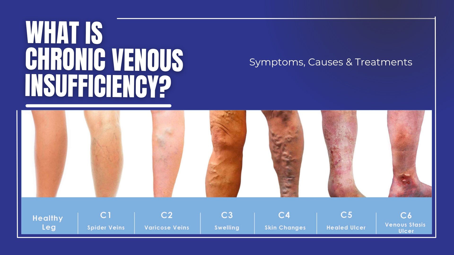 Ankle Discoloration – What is Stasis Dermatitis? - Veins Charlotte Blog