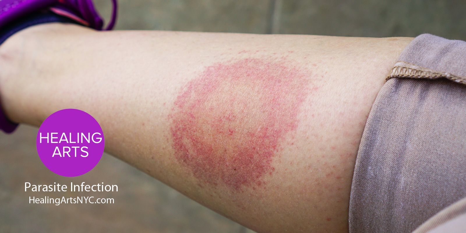 Parasite Infections NYC - Dr. Alicia Armitstead