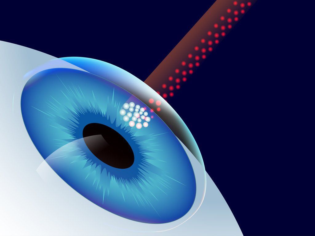How Long Does LASIK Eye Surgery Last? Permanent or Temporary?