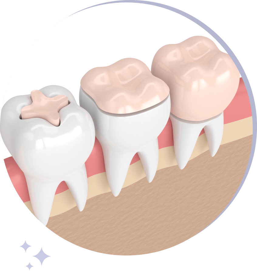 Inlays, Onlays, & Dental Crowns | Gallatin Dental Group