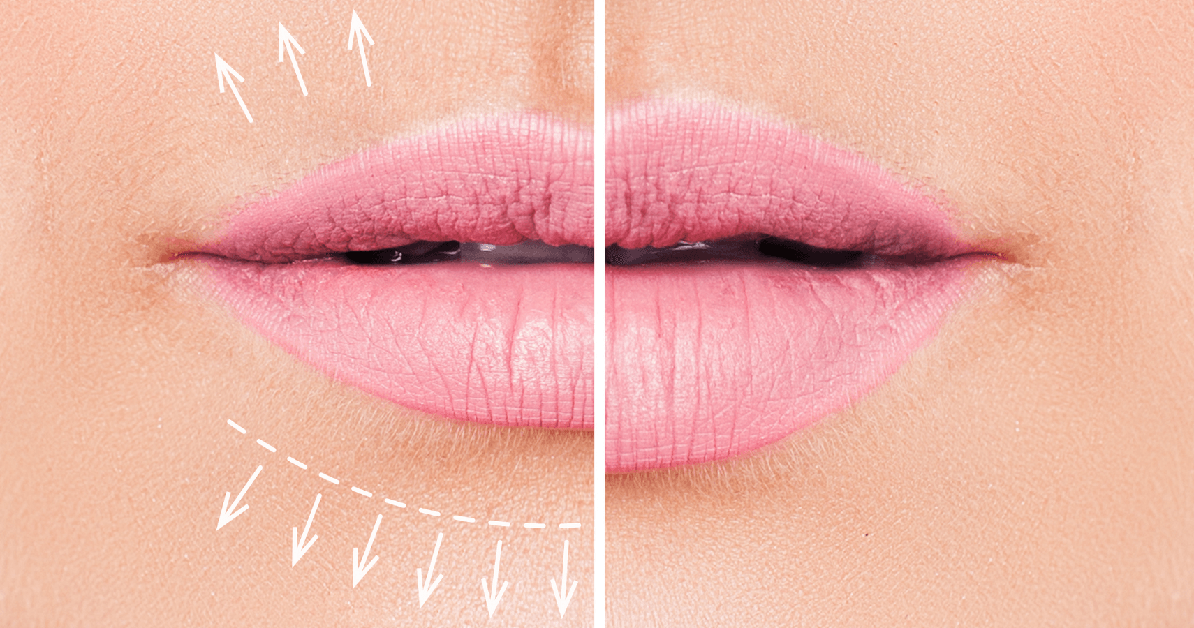 Preenchimento Labial 6 Pontos Que Você Precisa Saber