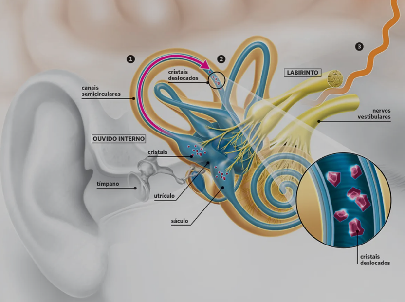 Vertigem Posicional Paroxística Benigna (VPPB): O Que Você Precisa Saber.