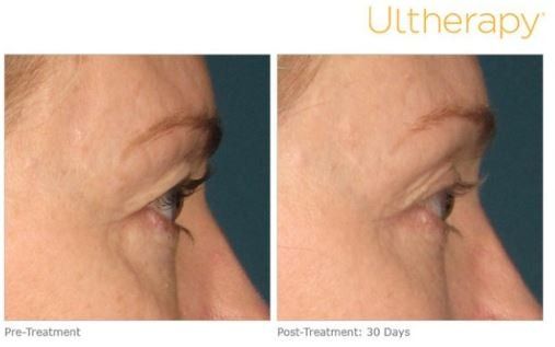 Ultherapy near Holmdel, NJ | Lotus Health And Aesthetics Spa