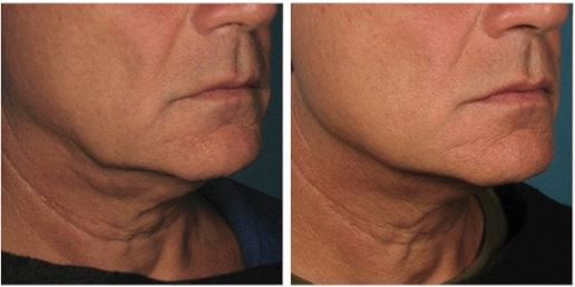 Ultherapy near Holmdel, NJ | Lotus Health And Aesthetics Spa