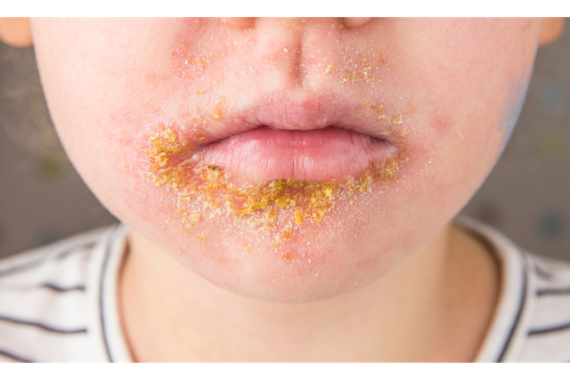 Impetigo Treatment Nircas Treatment System