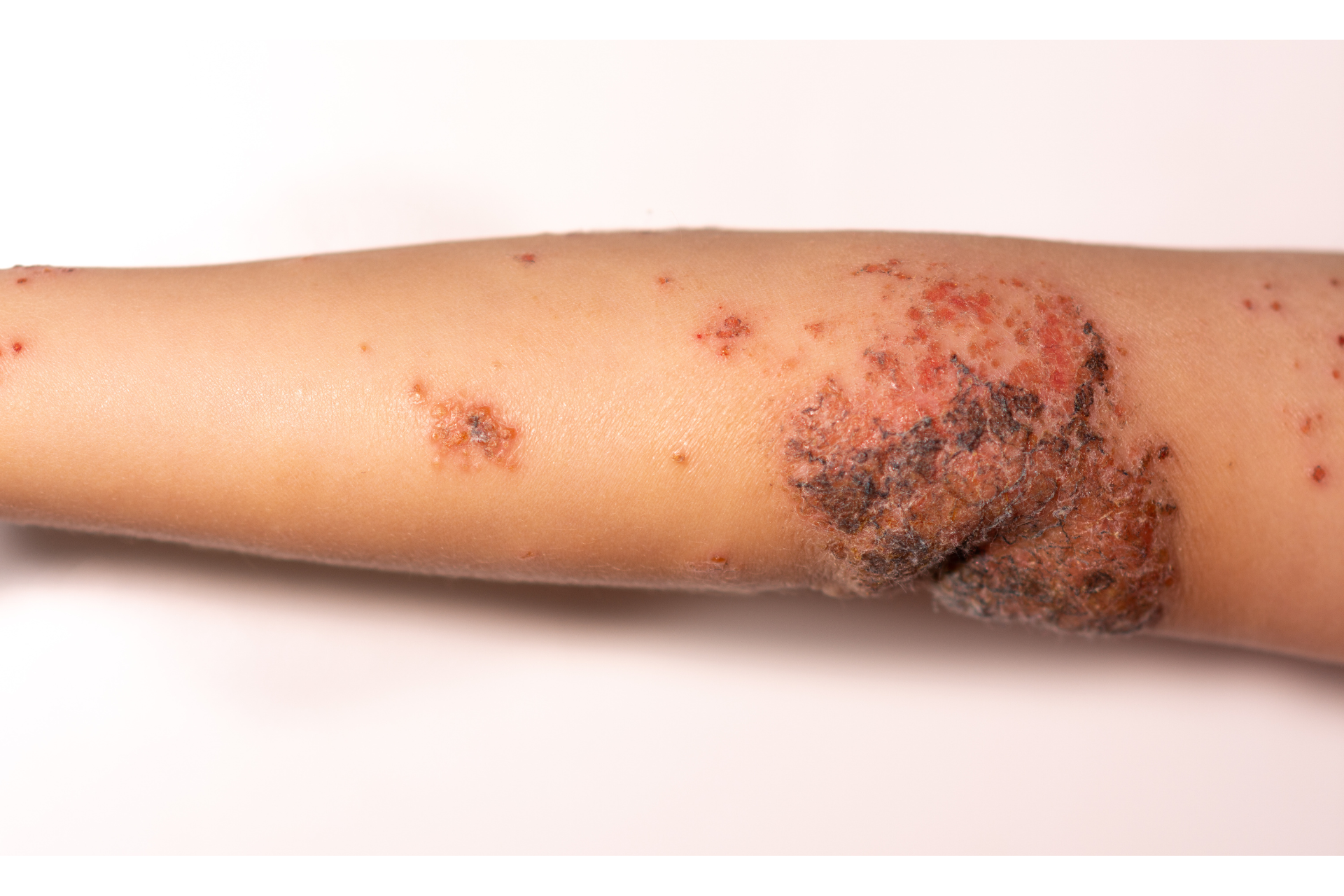 Impetigo Treatment Broadstairs - Pharmacy First