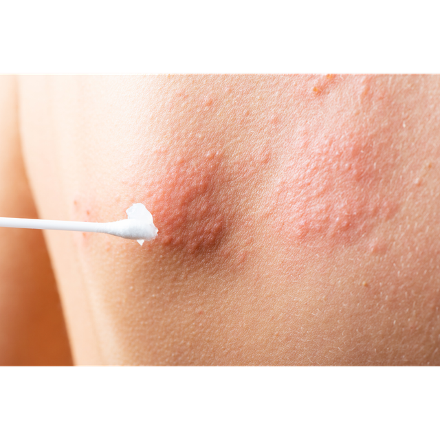 Shingles Early Symptoms