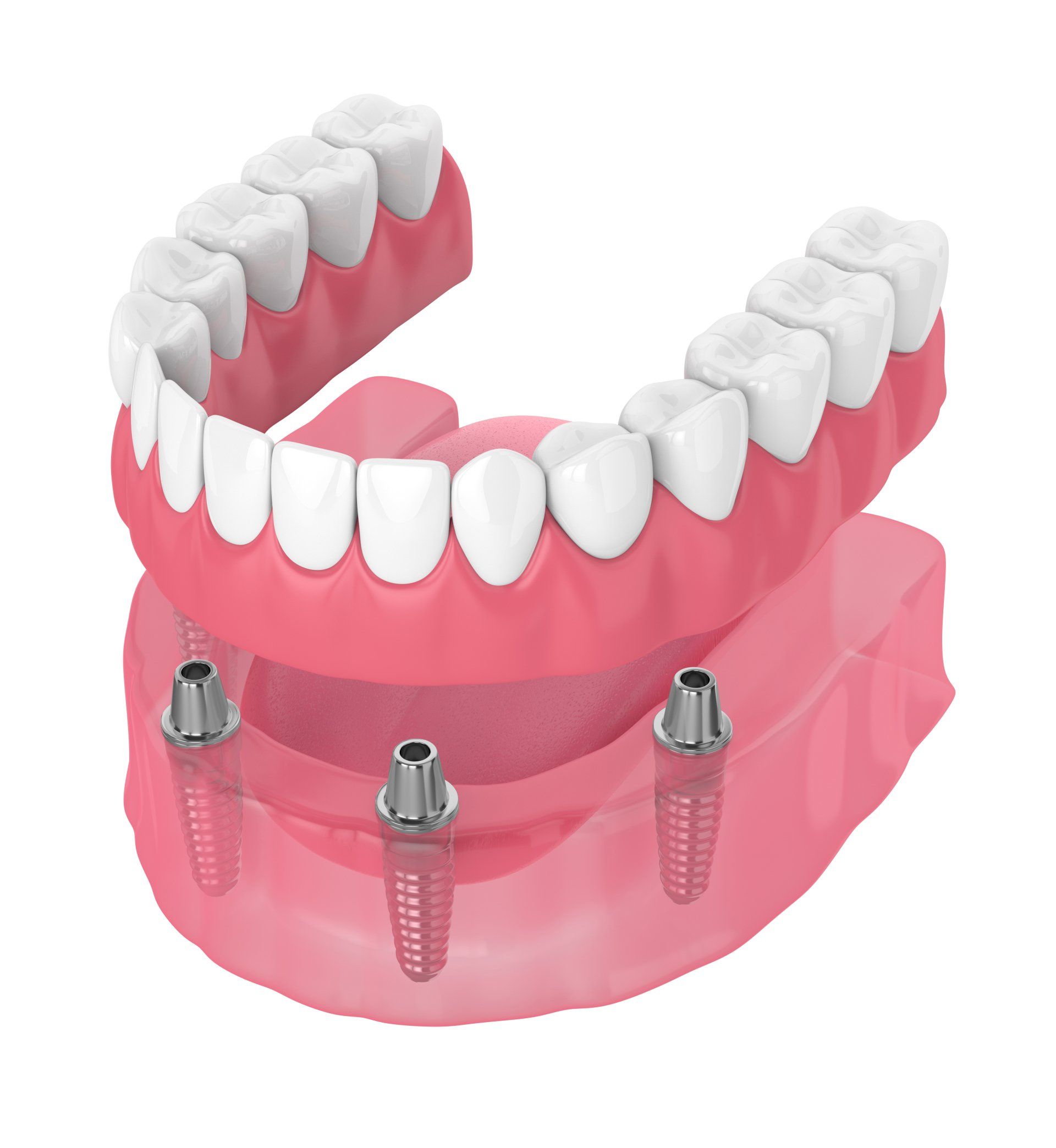 Secure Implant Supported Dentures in Riverview, FL