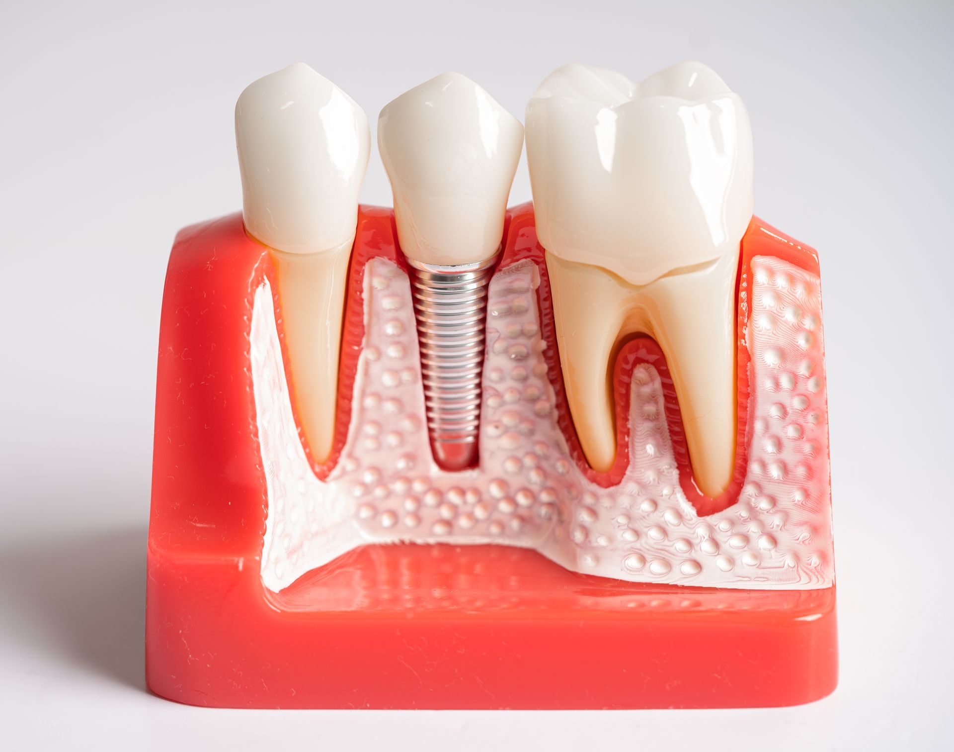All-On-4 Dental Implants: A Revolutionary Solution