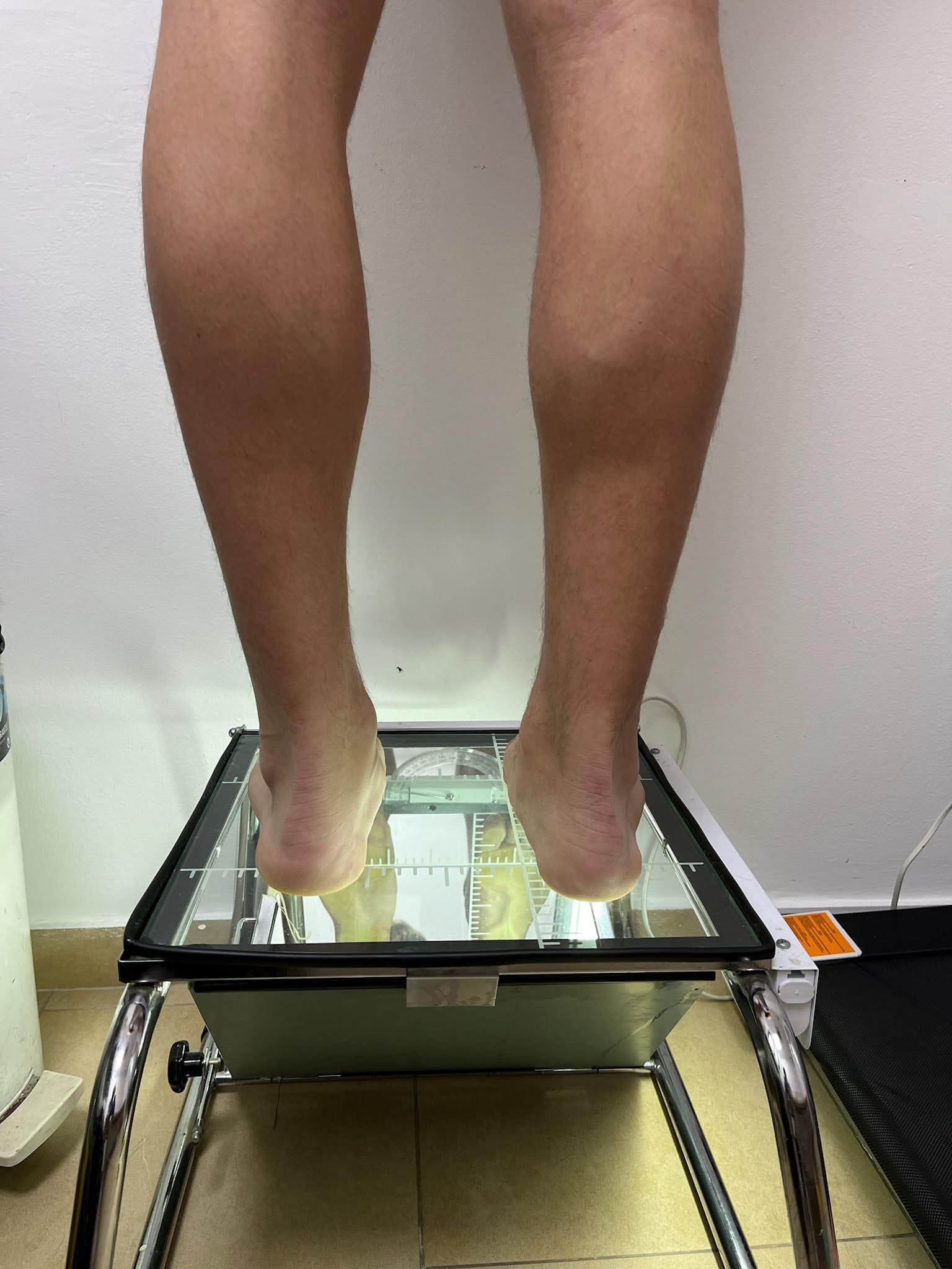 Estudio de la pisada ¿En qué consiste?