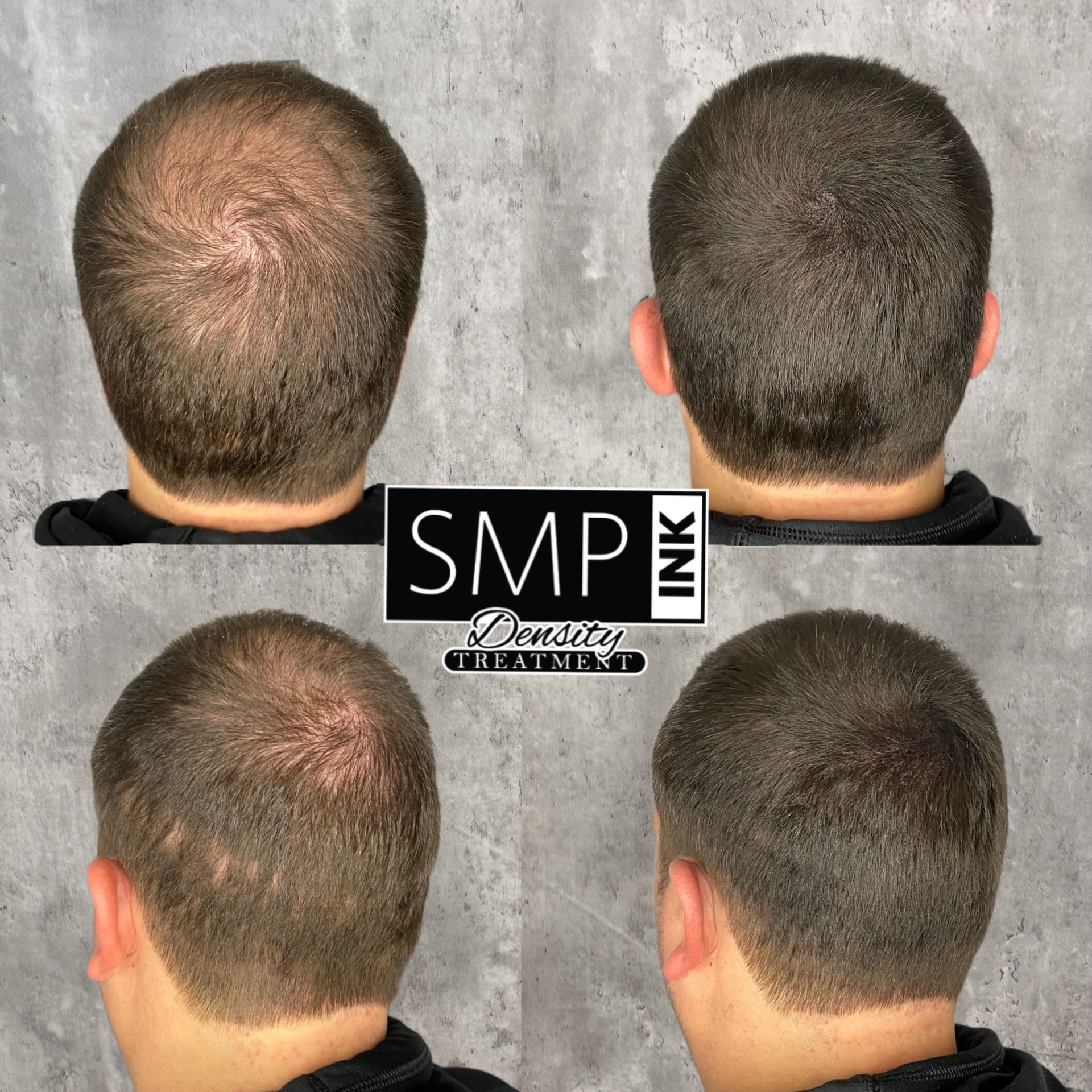 Scalp Micropigmentation | SMP INK | Las Vegas