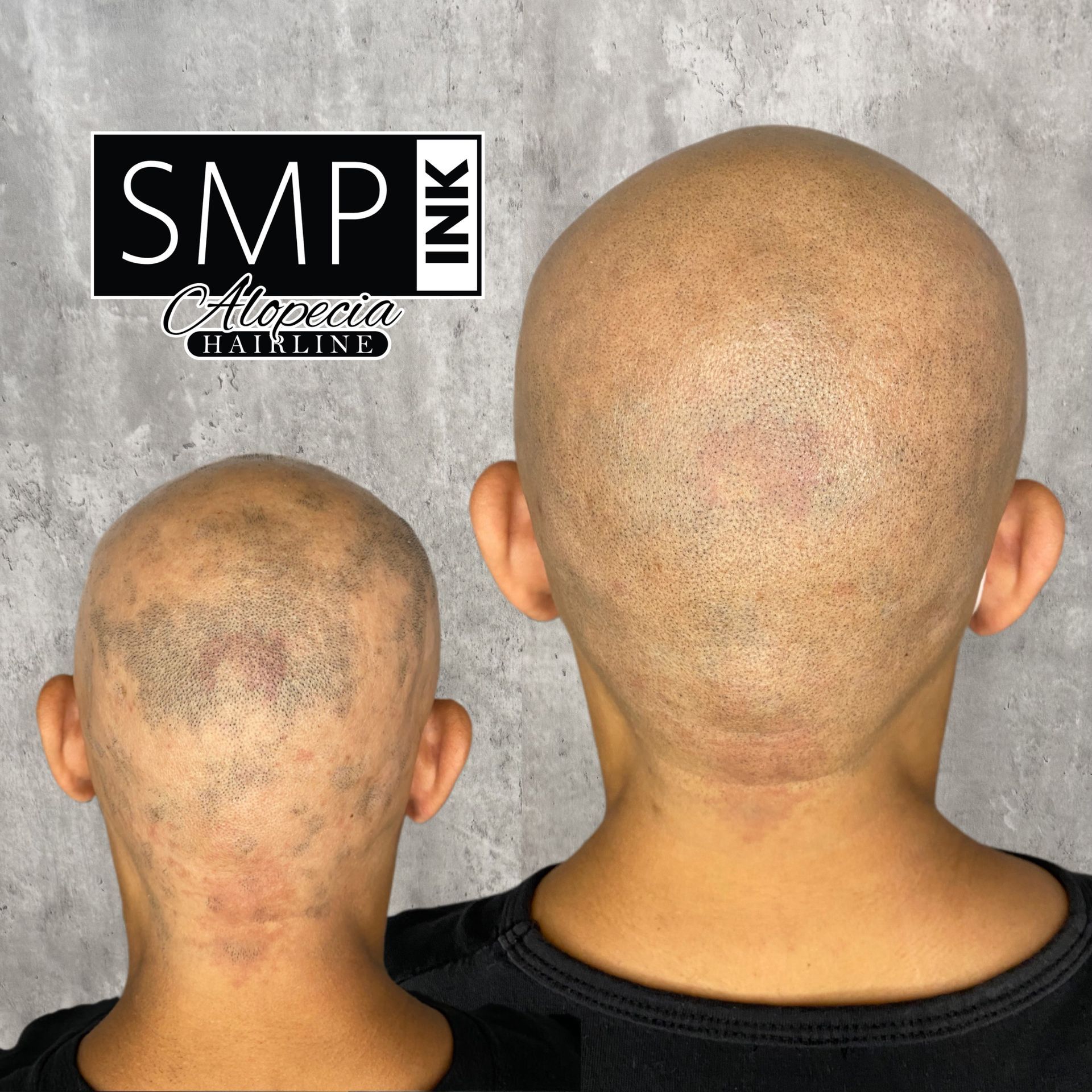 Scalp Micropigmentation | SMP INK | Las Vegas
