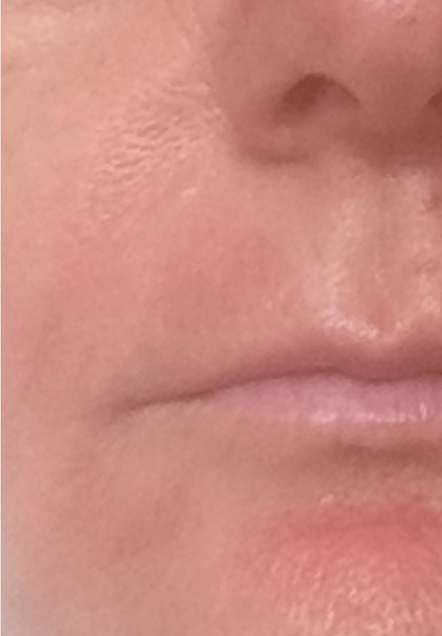 Pyruvic Chemical Peel | Anti-ageing Treatment Crosby | The Aesthetics Hub®️