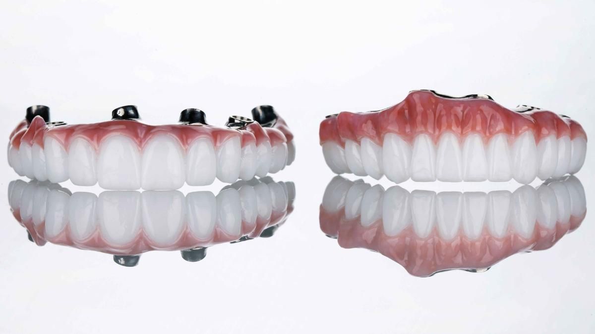 Screw Teeth in Implants: Procedure, Benefits & Costs