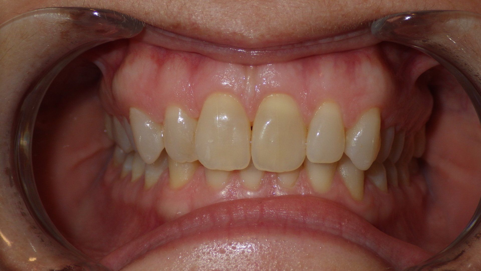 Dentist in Painted Post NY | Dentist 14870