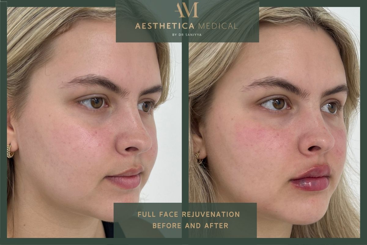 Face Rejuvenation Before & After Gallery | Aesthetica Medical