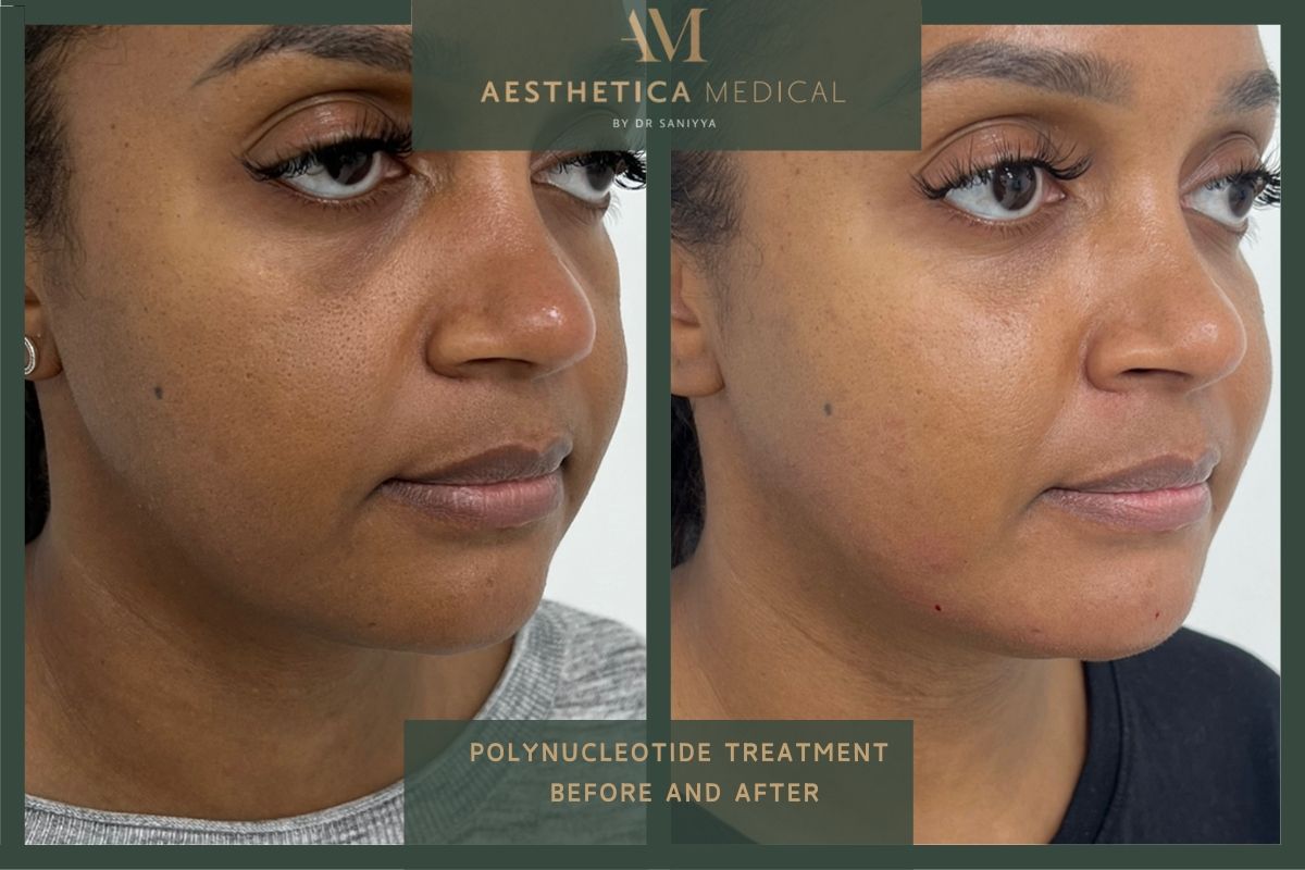 Polynucleotide Before & Afters Gallery | Aesthetica Medical