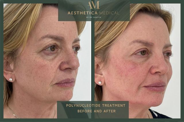 Polynucleotide GraziaBeauty Your Skin Has A New, Shiny Best Friend ...