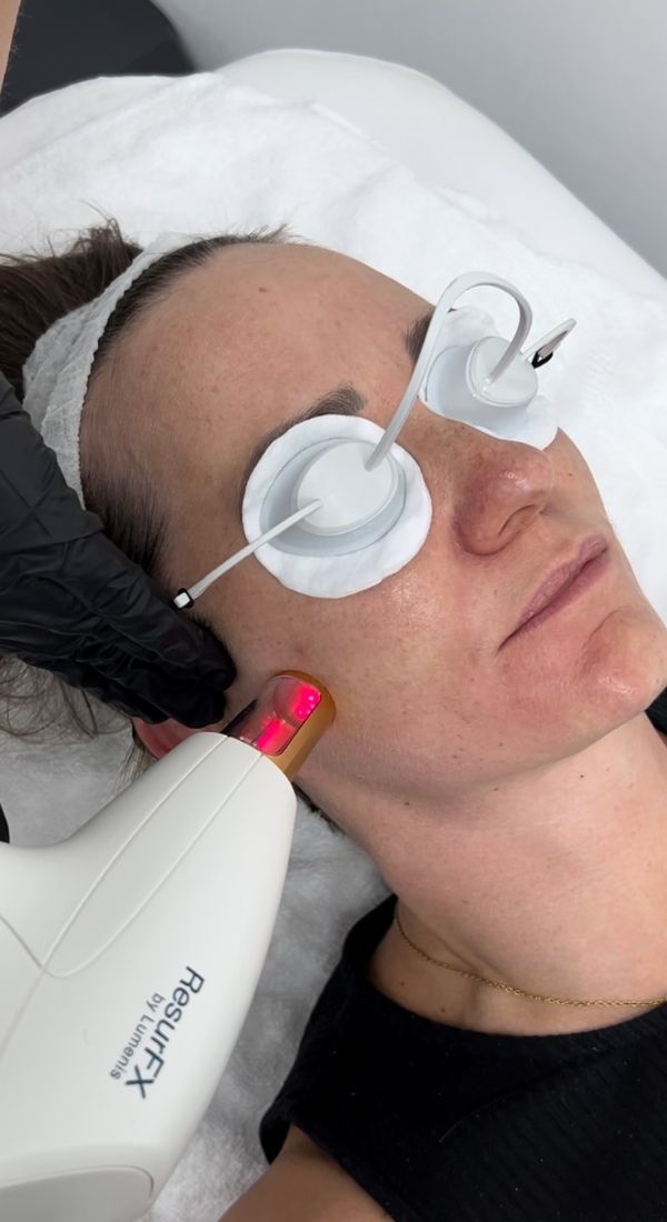 PhotoClear Treatment Leeds & Cheshire| Laser Skin Rejuvenation | Treat ...
