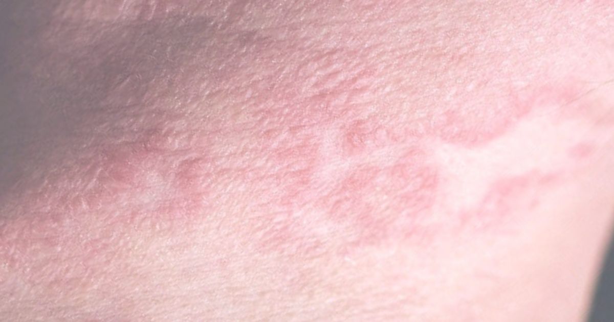 LED Therapy for Eczema | Aesthetica Medical Leeds