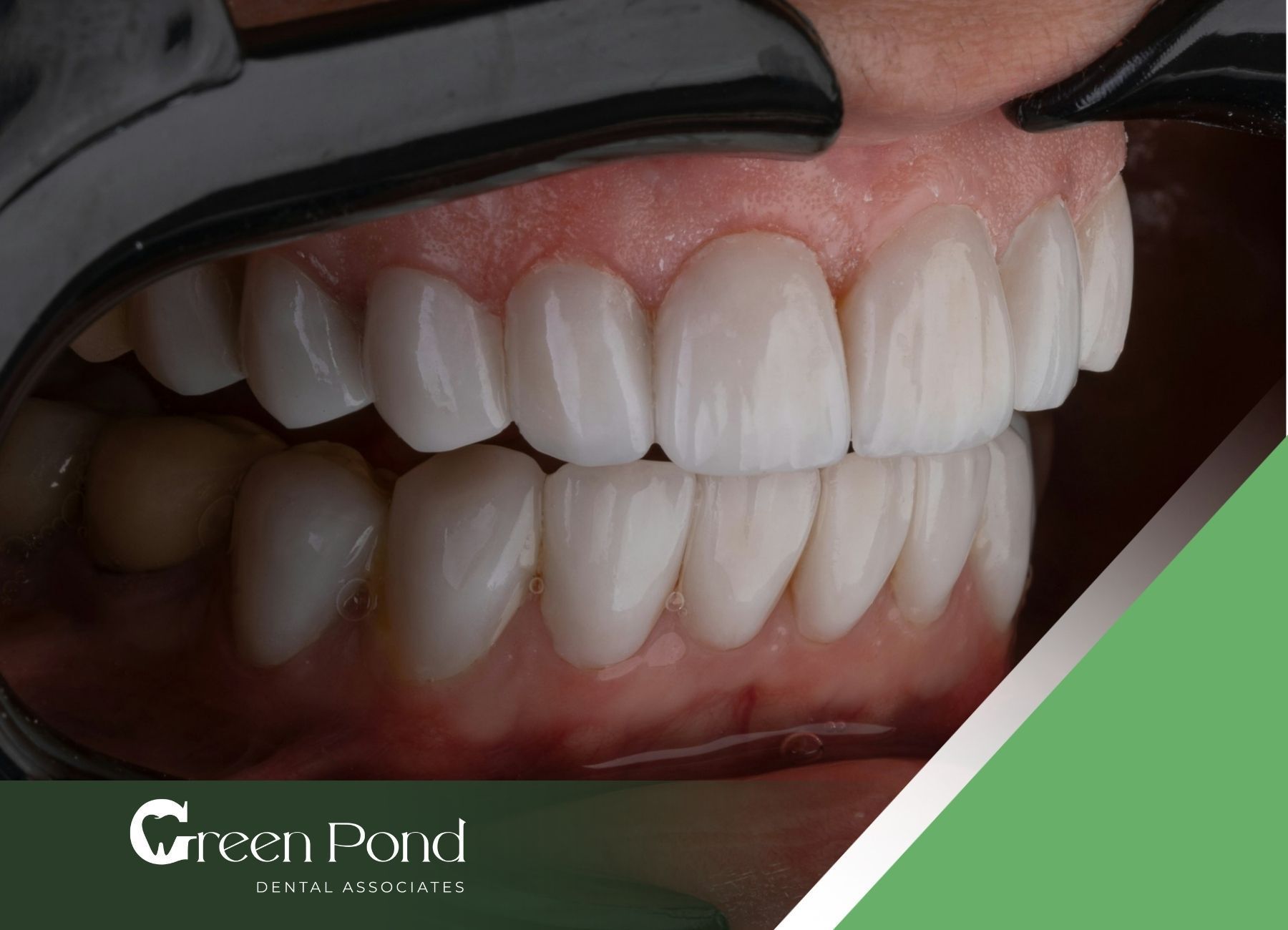 How Long Do Dental Crowns Last? Lifespan and Care Tips