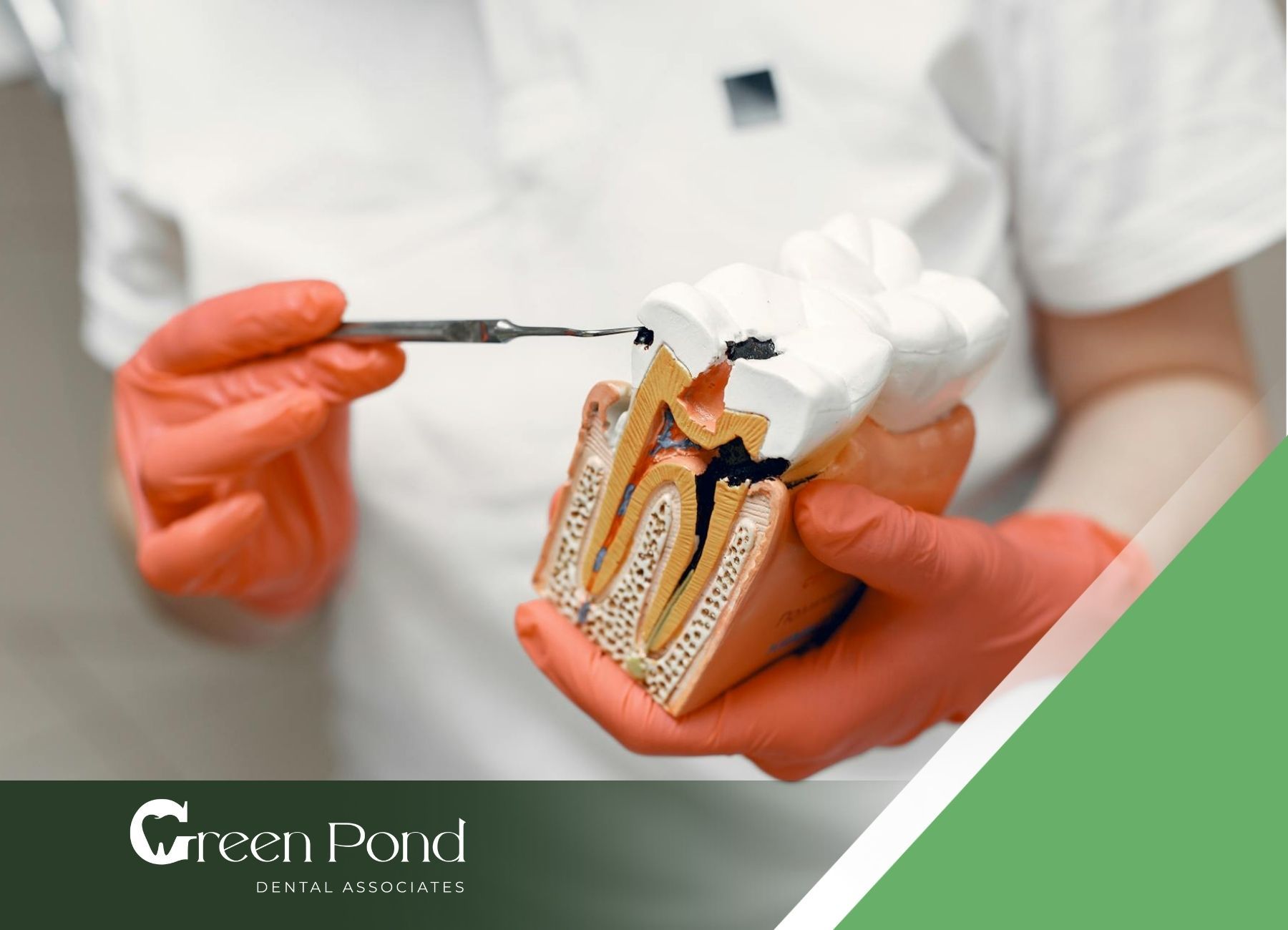 Decay Under Crown: Sniffing Out the Telltale | Green Pond Dental