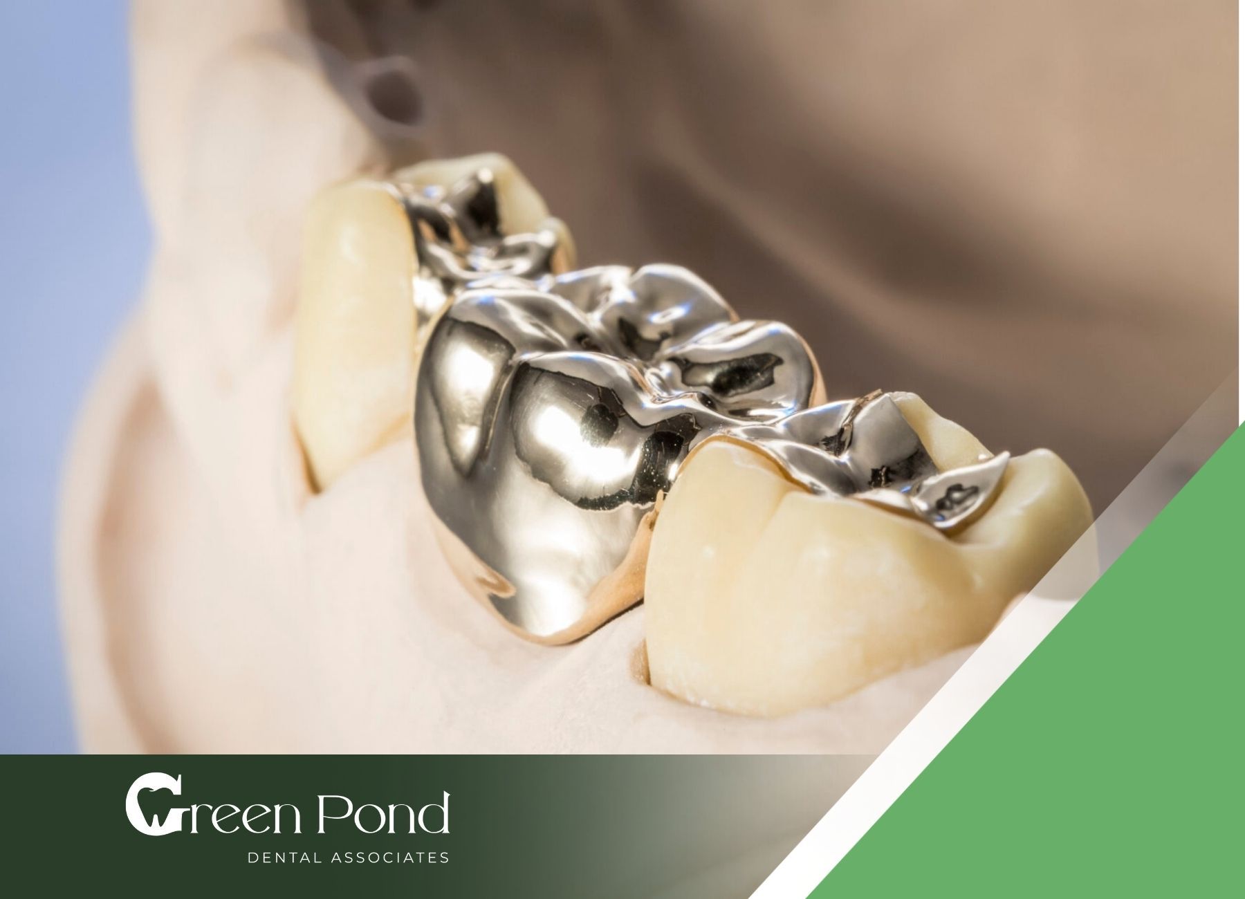 Metal Dental Crowns Durability | Green Pond Dental