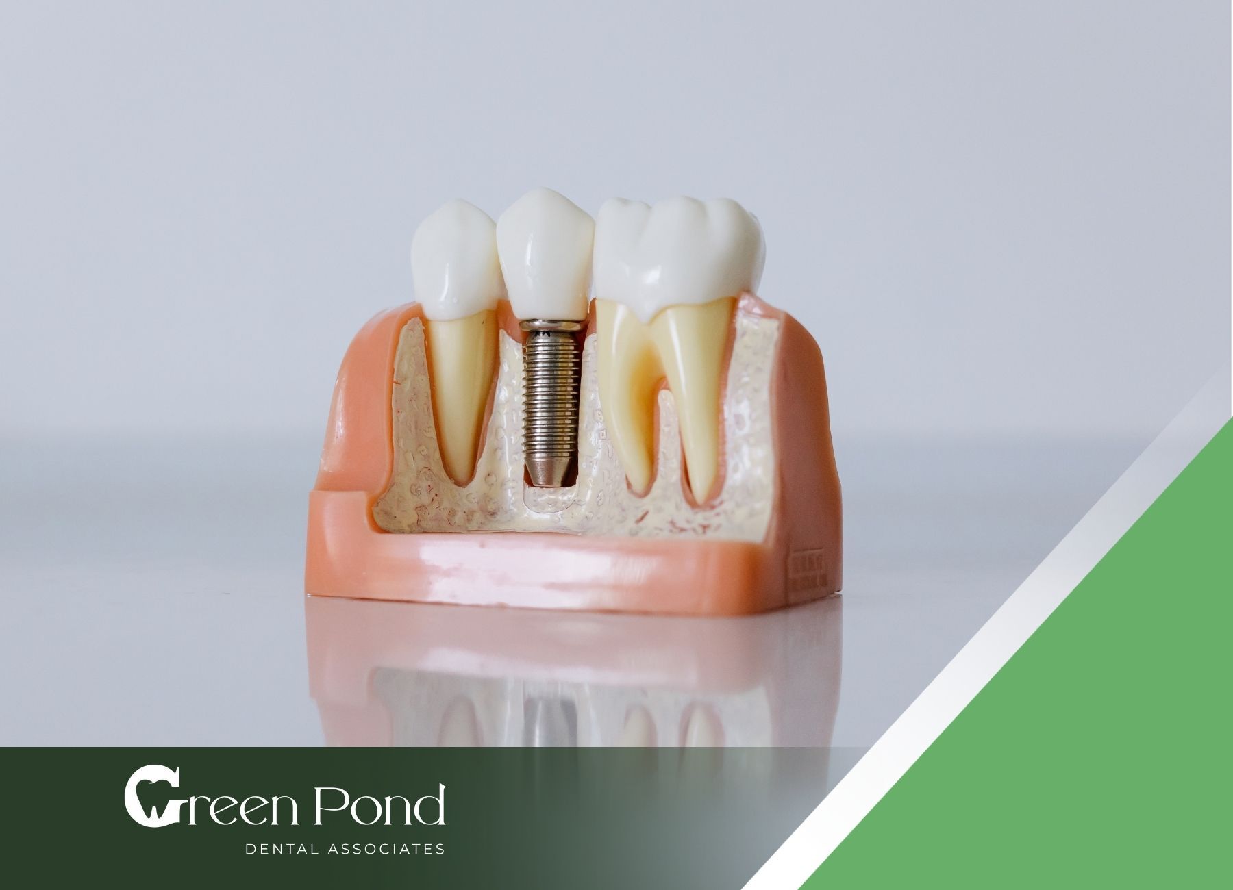 Best Full Mouth Dental Implants Options | Green Pond Dental