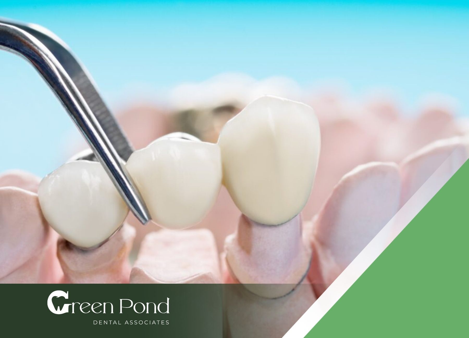 Ultimate Guide to Types of Dental Crown Options | Green Pond