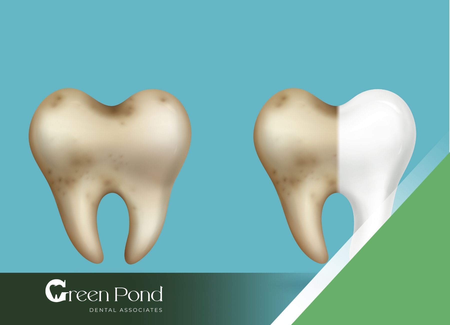 What is Plaque? Causes, Symptoms, and and How to Prevent it