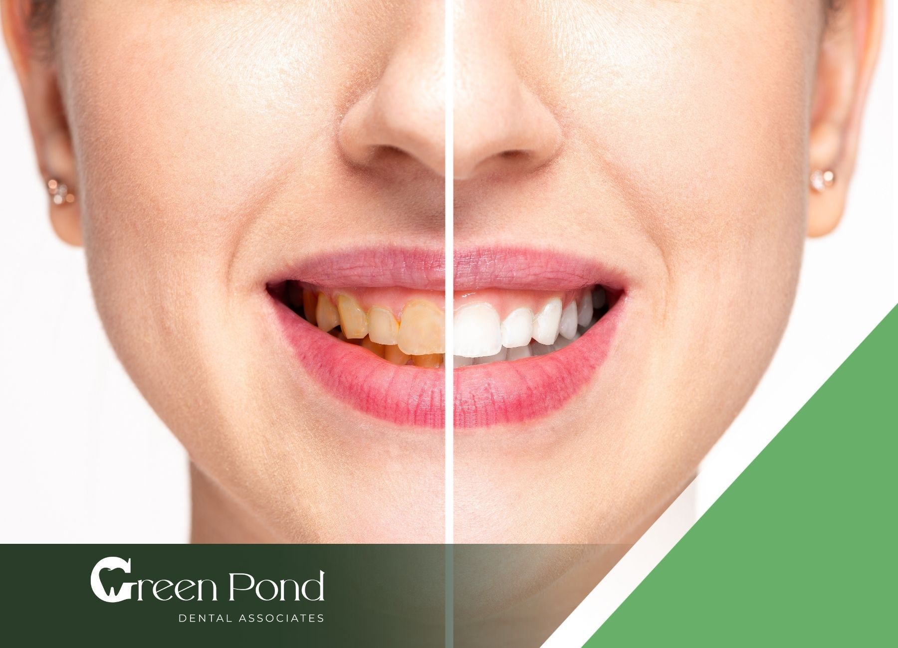 Does Green Tea Color Your Teeth | Green Pond Dental
