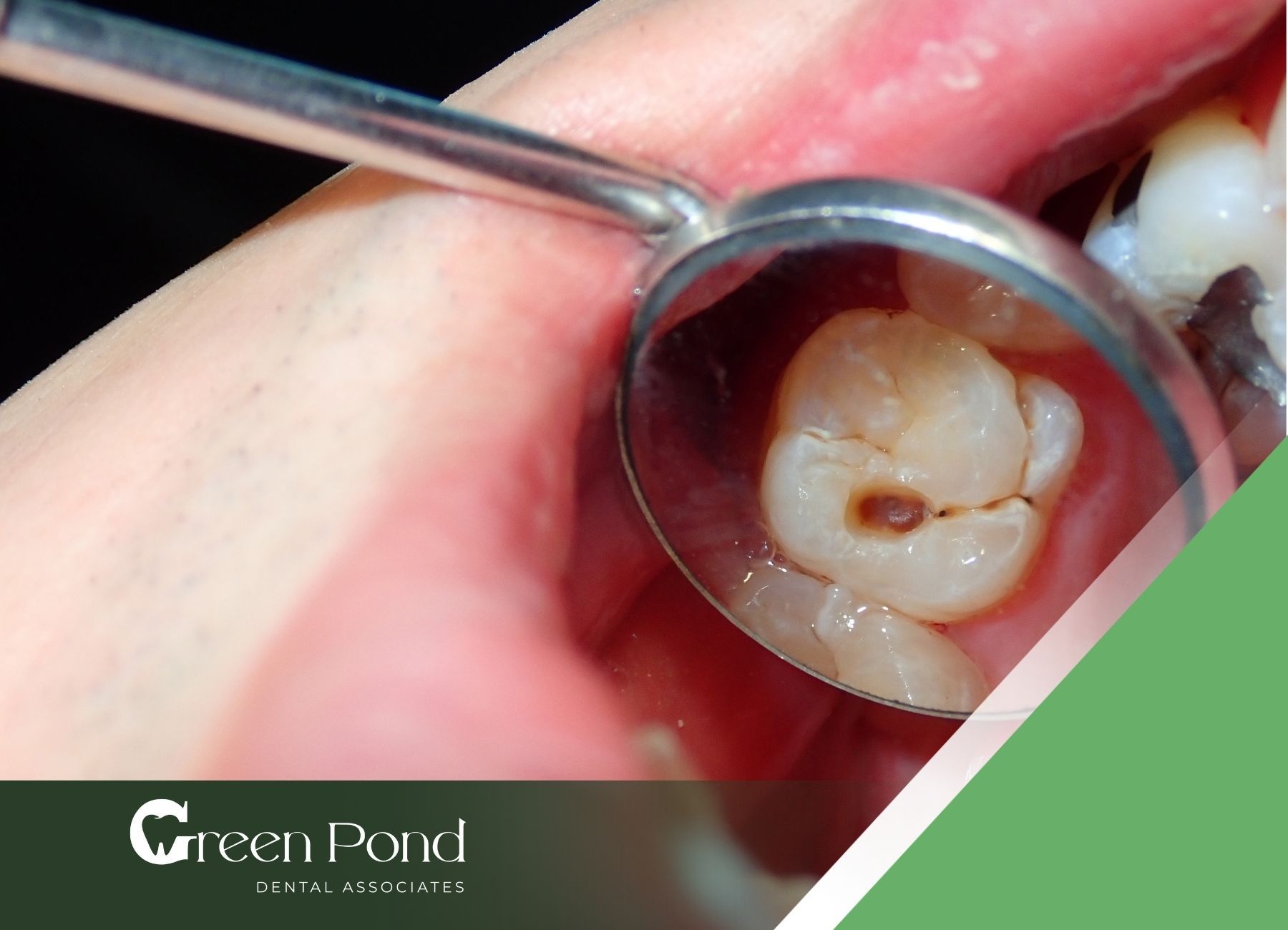 10 Dental Filling Symptoms to Watch Out For | Green Pond Dental