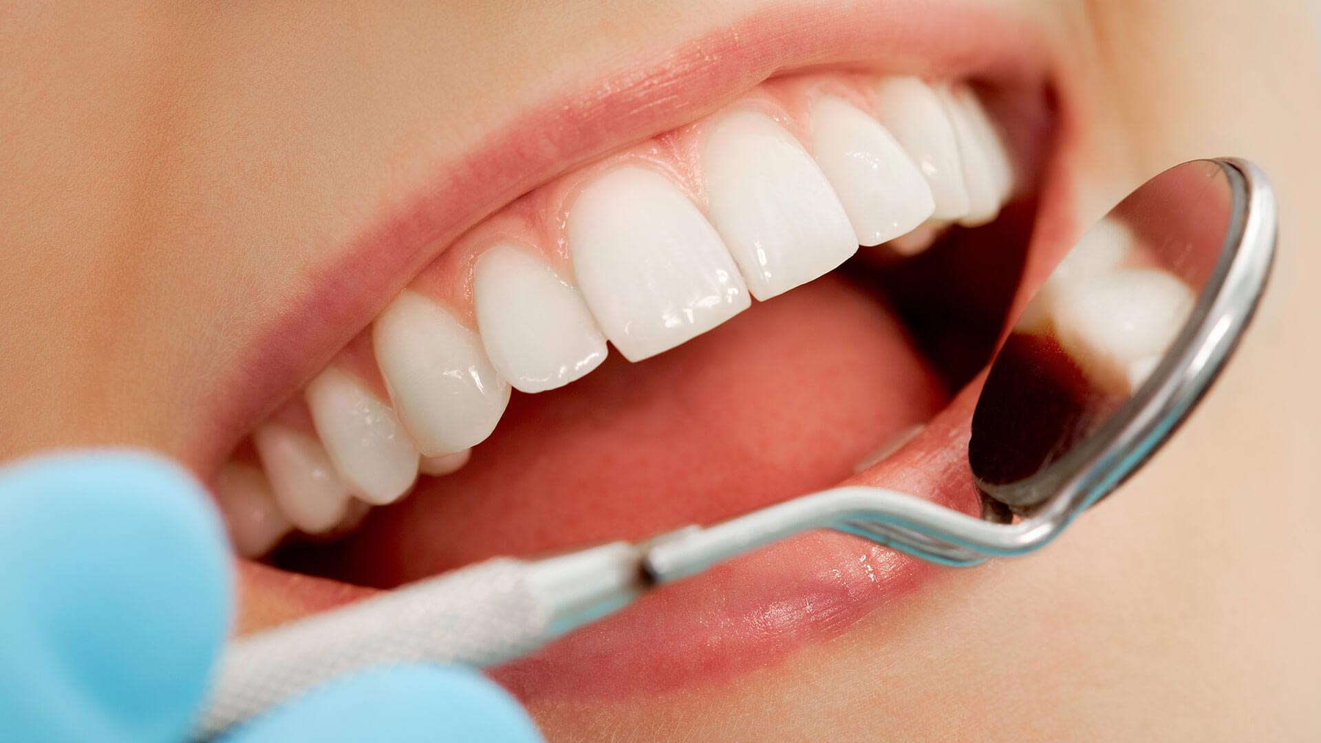 Why Dental Fillings Fail and What to Do About It