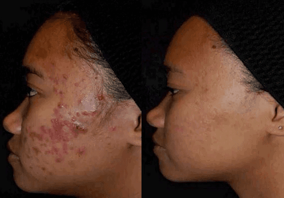 Virtual Online Acne Program For Effectively Treating Your Skin At Home