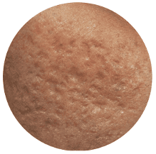 How to Get Rid of Acne Scars