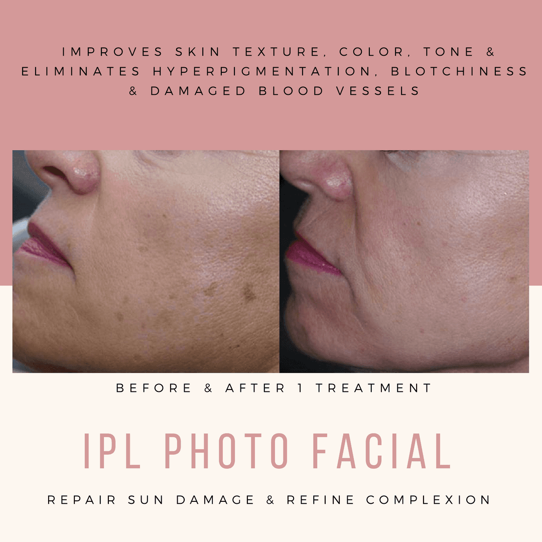 IPL Photo Facial Skin Rejuvenation & Spot Reduction| Philadelphia