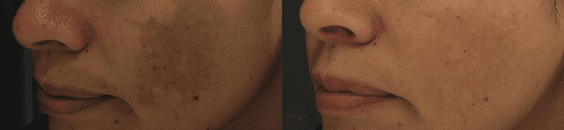 Laser Genesis Philadelphia Minimize Large Pores Oily Skin And Acne