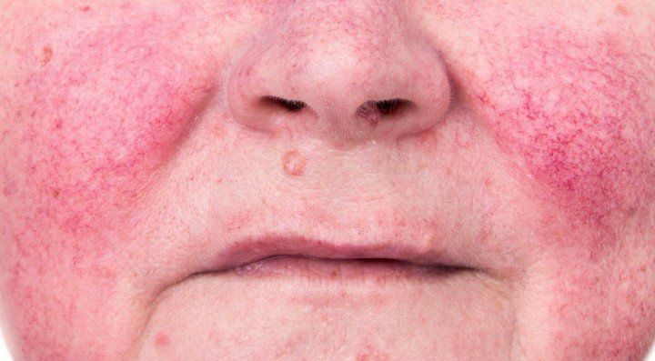 What is Rosacea? And How To Treat Rosacea