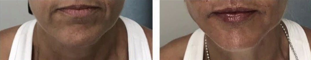 Monaco MedSpa Before and After Gallery, Real Clients, Real Results