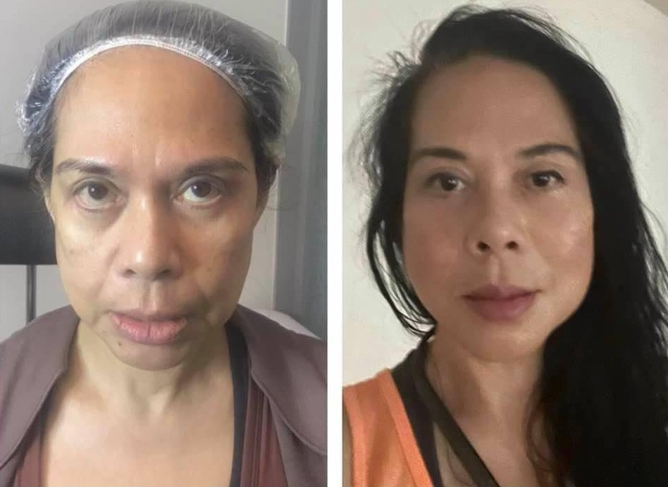 Monaco MedSpa Before and After Gallery, Real Clients, Real Results