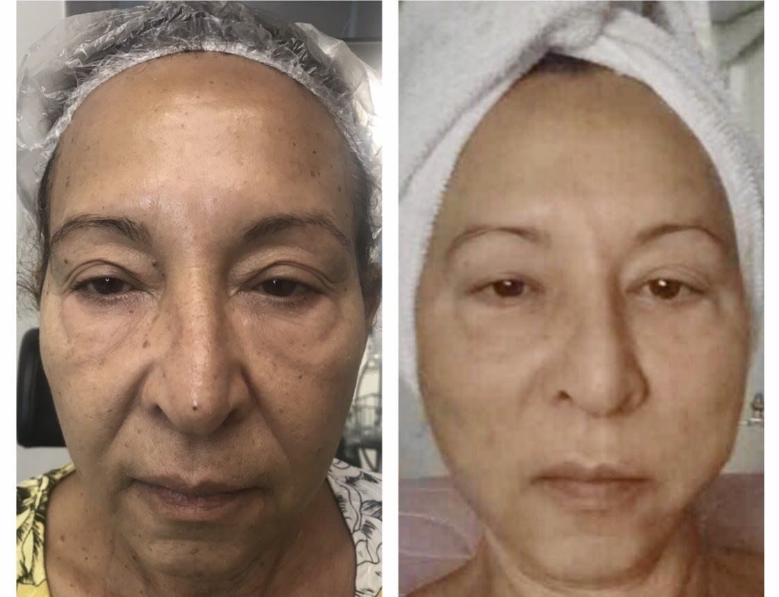 Monaco MedSpa Before and After Gallery, Real Clients, Real Results
