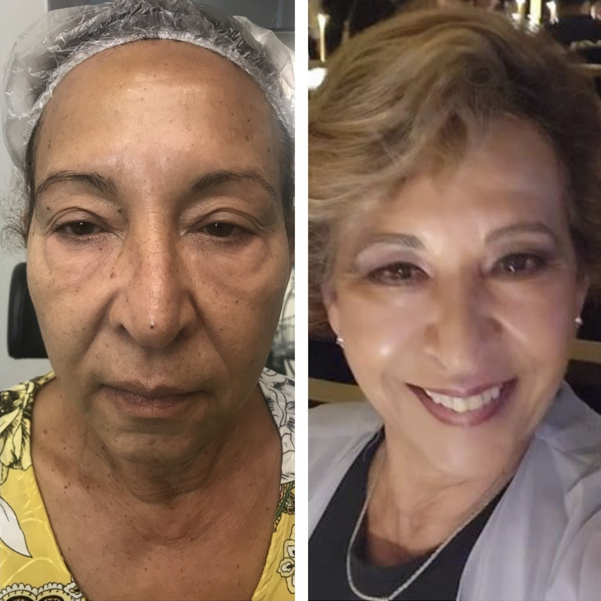 Monaco MedSpa Before and After Gallery, Real Clients, Real Results