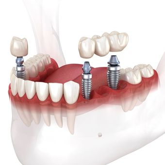 SMILE HAUS | General & Cosmetic Dentist: West Hills CA